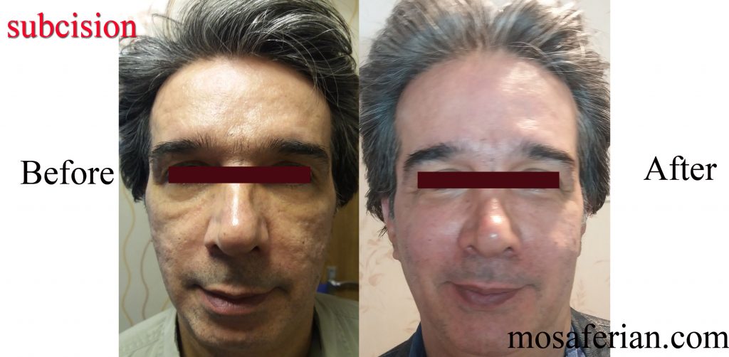 subcision is a special type of acne treatment for deep scars