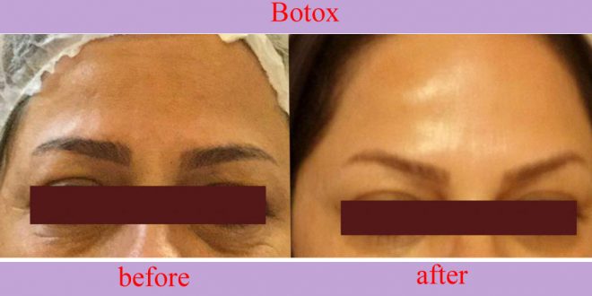 after botox what to do for better results and prevention of side effects