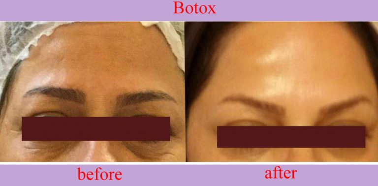 after botox what to do for better results and prevention...
