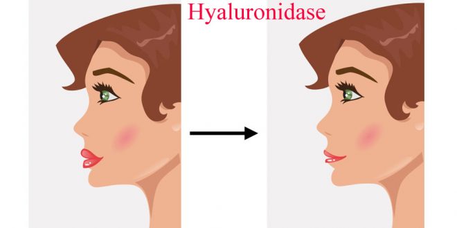 Hyaluronidase is routinely used for reversing hyluronic