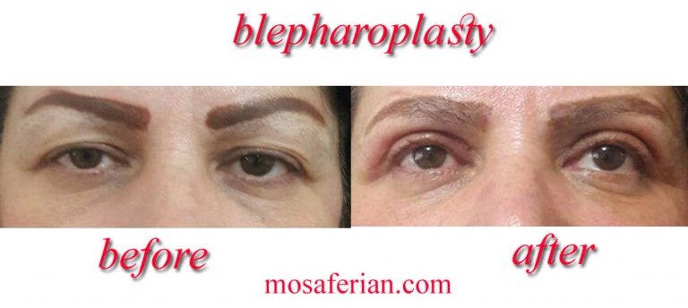 Blepharoplasty cost vary depending on the area: lower or upper