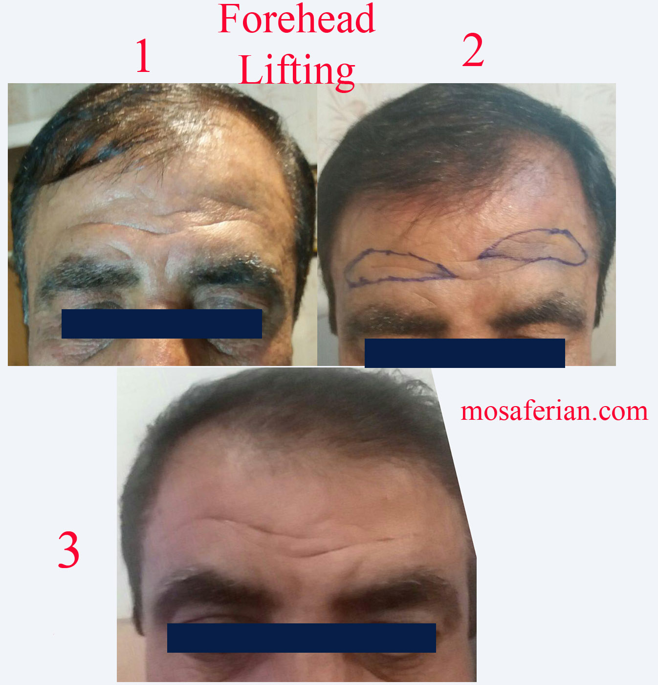 brow lift scars - Niayesh Beauty Clinic Brow lift scars