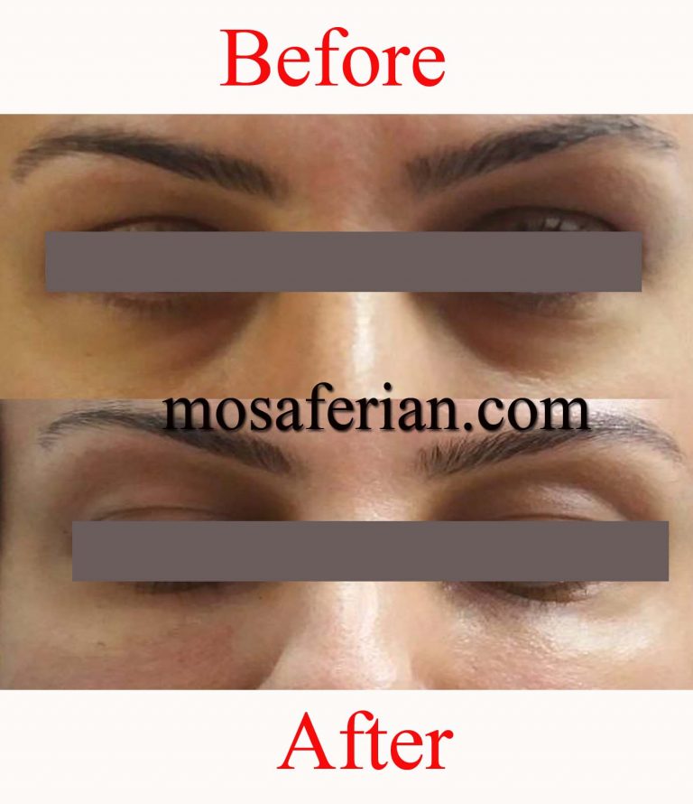 Tear trough correction is an advanced technique and...