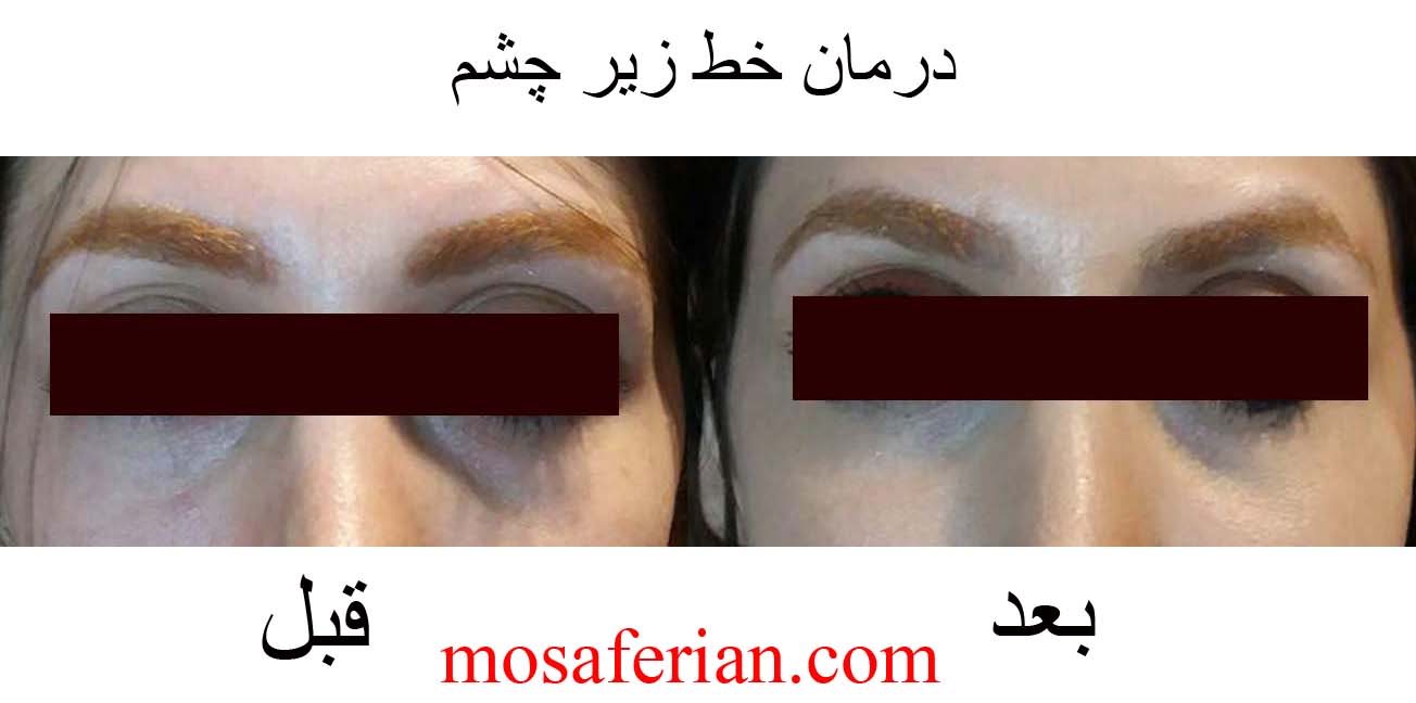 Tear trough correction is an advanced technique and...