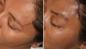 Brow lift scars