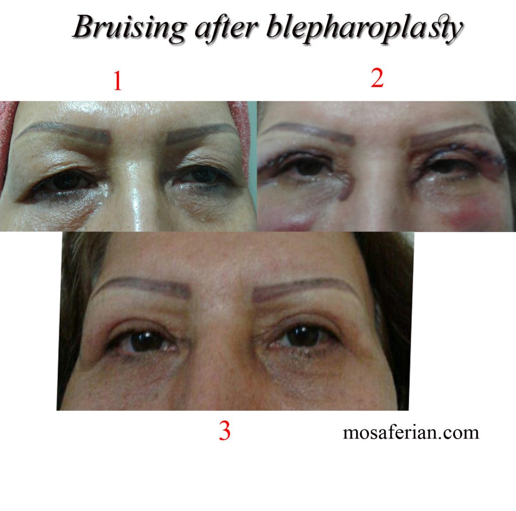blepharoplasty scars - Niayesh Beauty Clinic blepharoplasty scars
