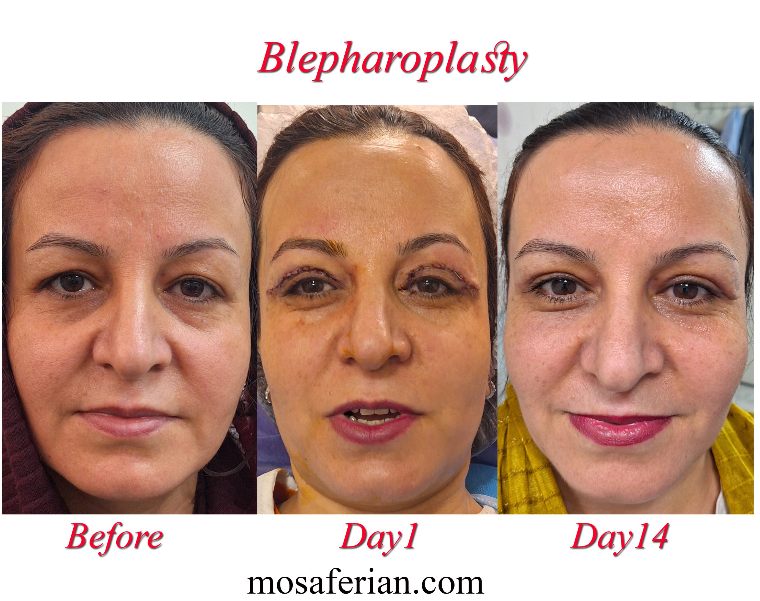 blepharoplasty scars
