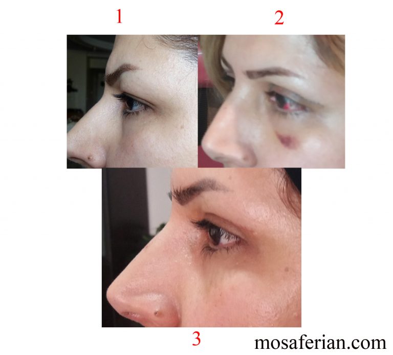 blepharoplasty scars before and after photos - blepharoplasty scars