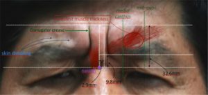 How common is droopy eyelid after botox droopy eyelid botox