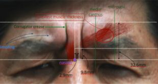 skin rejuvenationِ,botox ,Hifu treatment at Dr. Mosaferian Beauty Clinic