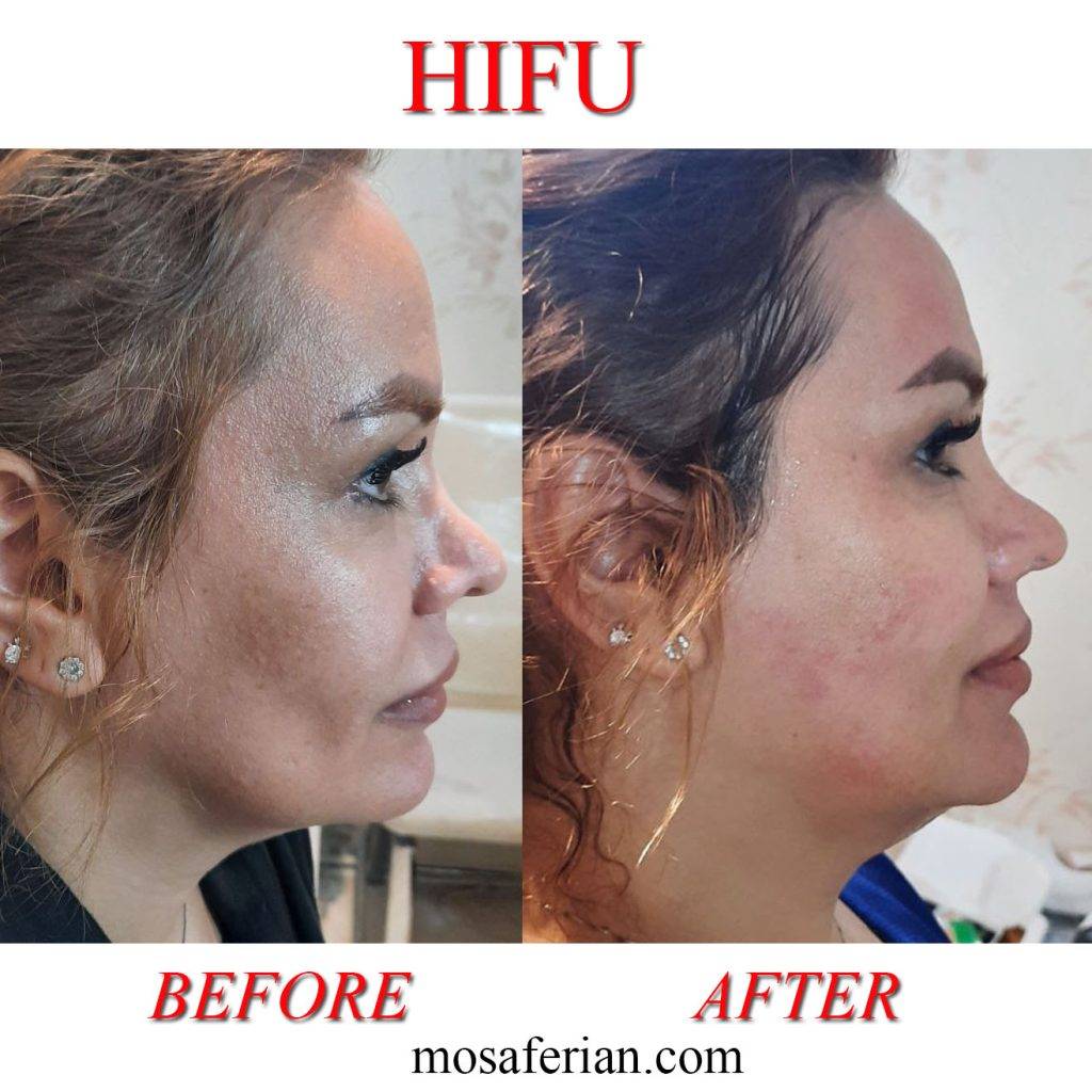 hifu treatment lifts and tightens skin for a non surgical face lift