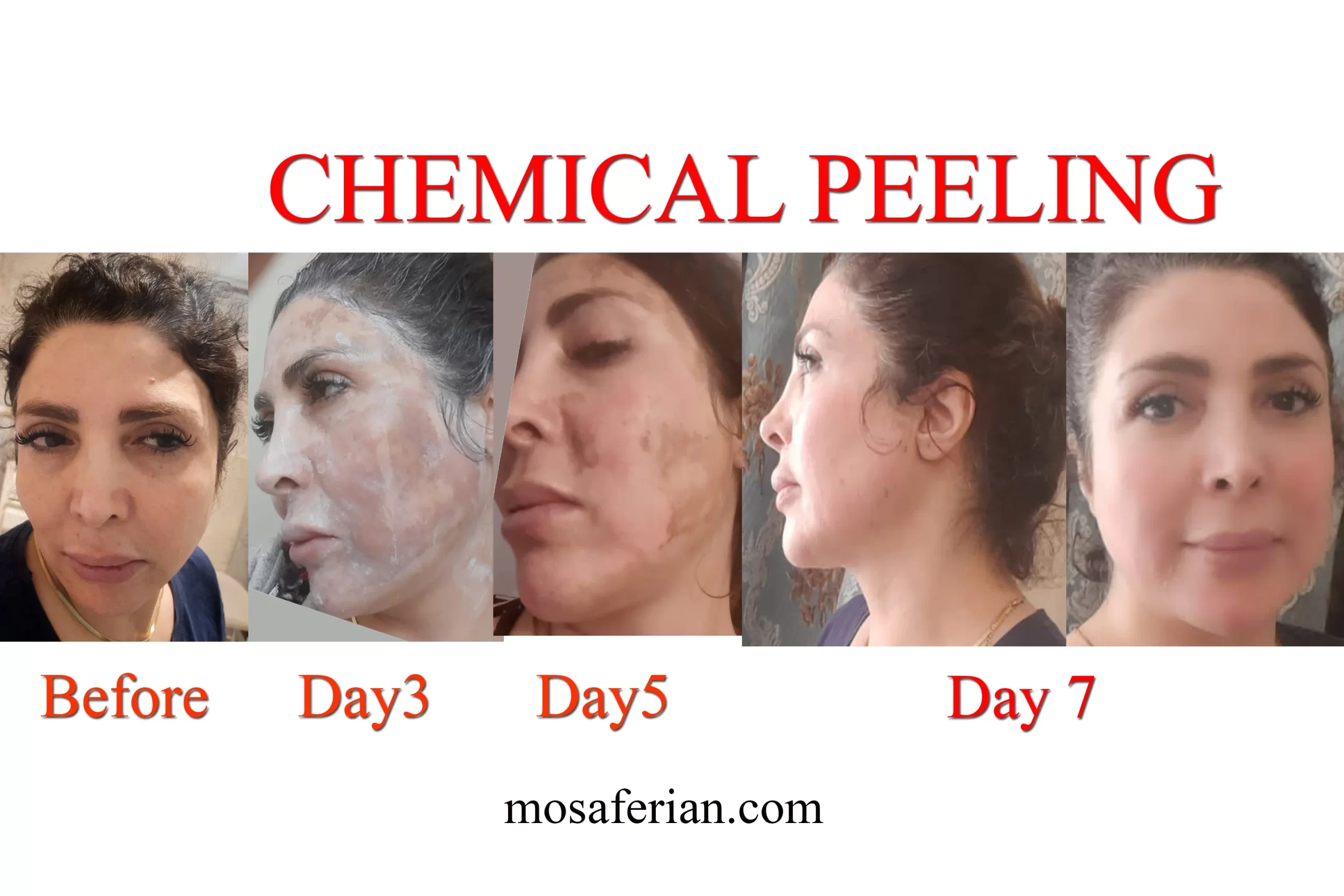 Skin chemical peel is a procedure in which a chemical solution...