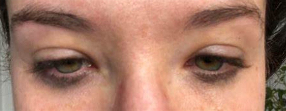 botox side effects include: Pain, swelling or bruising at the injection